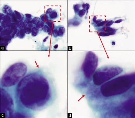 Atypical Glandular Cells AGC Cytology Of Glandular Lesions Of The Uterine Cervix CytoJournal