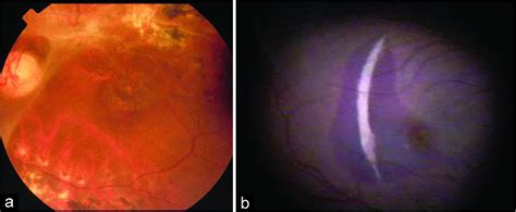 Traumatic Macular Hole Clinical Aspects And Controversies Latin