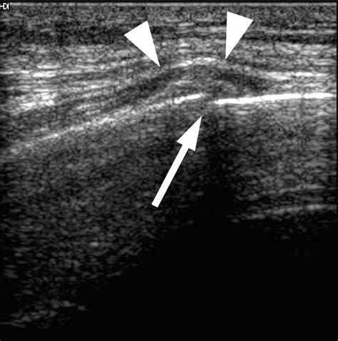 Rib Fracture Vs Metastasis At Emmett Hunt Blog