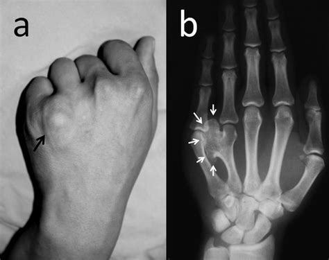 A No Limitation Of Motion In Metacarpophalangeal Joints B Initial X Ray Download Scientific