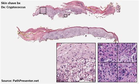 Dr Travis Brown On Twitter Histology Microbiology Flash Card Cryptococcus Infection