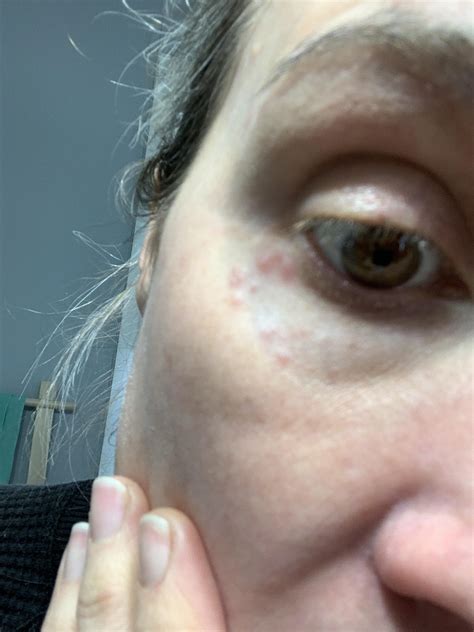 What Are These Bumps Under My Eye More Info In Comments Rdermatologyquestions