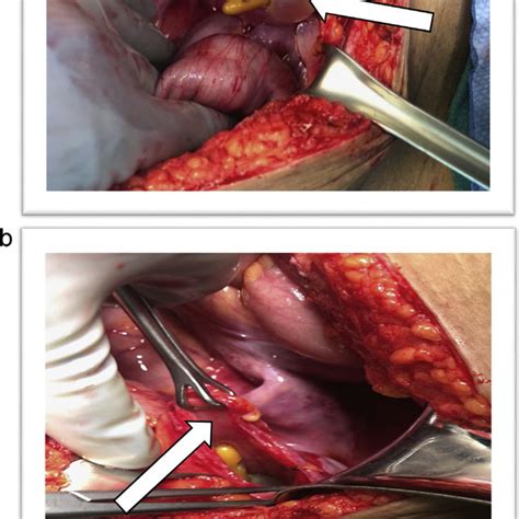 A Intraoperative View Of Low Midline Laparotomy Showing Ruptured