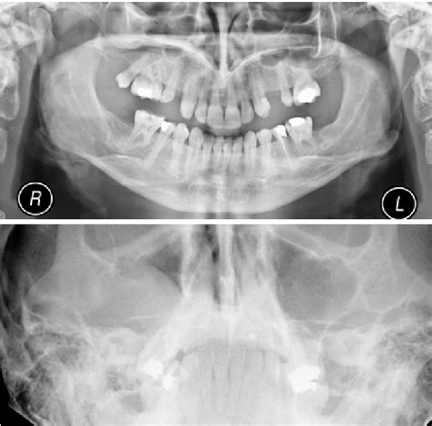 A Dpt Showing Radiological Features Of A Malignancy Of The Right