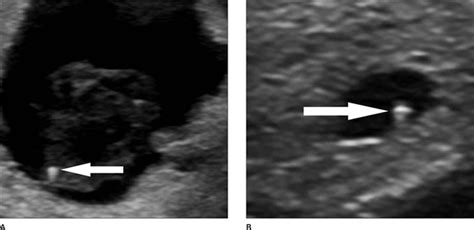 Nonshadowing Echogenic Foci In Thyroid Nodules Beland 2011 Journal Of Ultrasound In