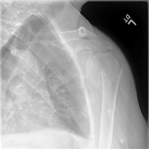 Xray Fracture Object Detection Model V1 2024 01 18 11 30am By Wkspaceone