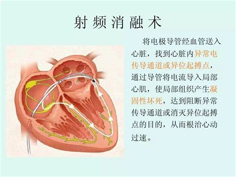 科普 什么样的患者适合心脏射频消融