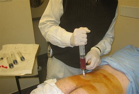 15 Unique Bronchoscopy Procedure Note