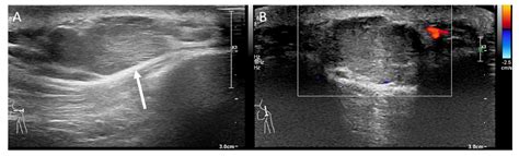 Subcutaneous Myoepithelioma In The Extremity A Potential Pitfall In