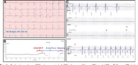 Figure 1 From Vasovagal Syncope With Isolated Atrioventricular Block