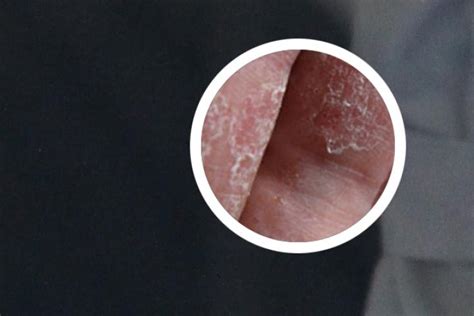 绥化银屑病医院绥化银屑病诊疗机构绥化银屑病诊疗中心预约平台 中原银屑病网