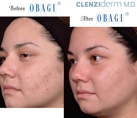 Obagi® Before And After Pictures Micki Ly M D Maui Dermatologist