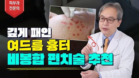 여드름 패인흉터 레이저 치료해도 효과가 없다면 비봉합 펀치술 알아보기🔎 여드름 흉터 없애는 방법 Youtube