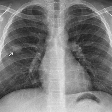 Pdf Pulmonary Inflammatory Myofibroblastic Tumor Report Of 2 Cases With Radiologic Pathologic