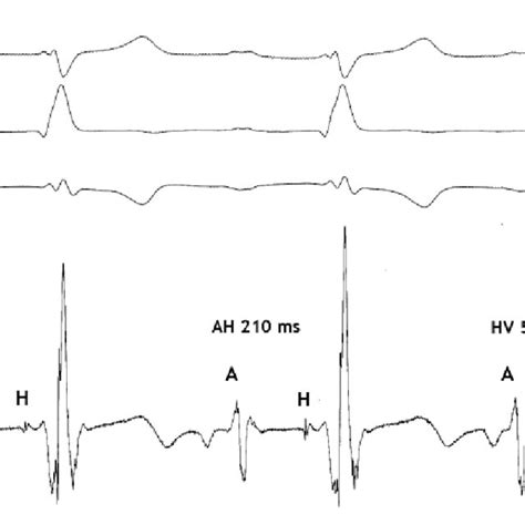 Intra Cardiac Recording Showing The Long Ah Interval 210 Milliseconds Download Scientific