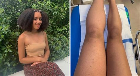 Teen Living With Lymphoedema The Same Condition As Linda Nolan