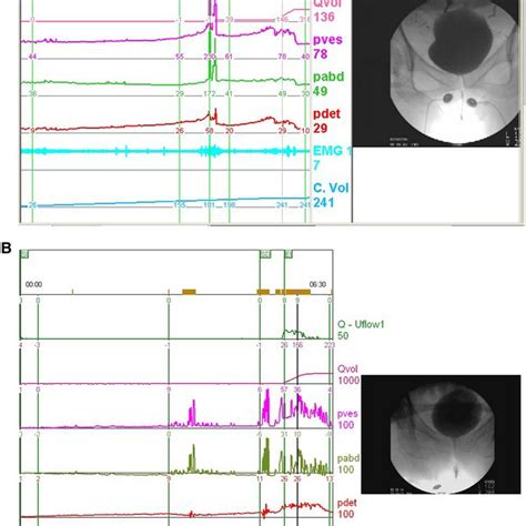 A Detrusor Underactivity In A Woman With Bladder Neck Obstruction Download Scientific