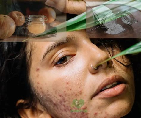 REVEALED Use These DIY Hacks To Get Rid Of Acne Overnight DIY Health Plus