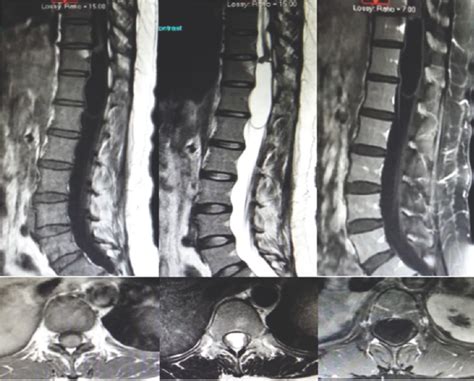 Spinal Arachnoid Cyst