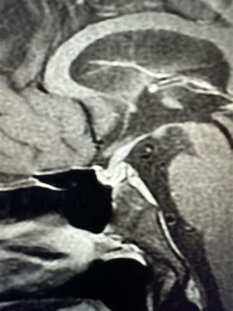Understanding Hypophysitis Symptoms Diagnosis And Treatment