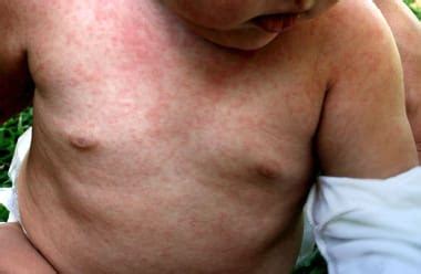 Roseola Infantum Practice Essentials Background Pathophysiology