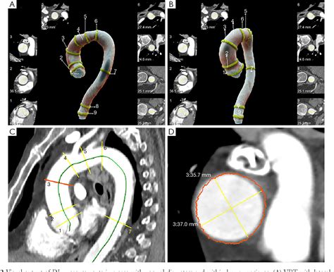 Figure 1 From Fully Automated Guideline Compliant Diameter Measurements Of The Thoracic Aorta On