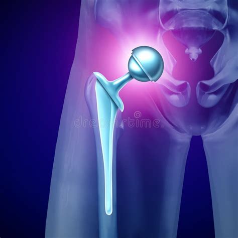 Hip Replacement Stock Illustration Illustration Of Socket 293756920