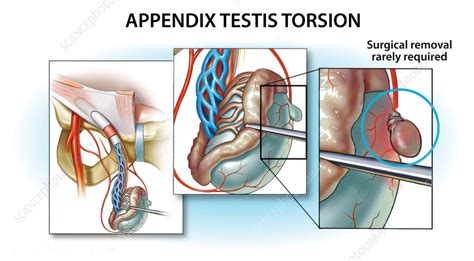 Torsion Of Appendix Testis Blue Dot Sign