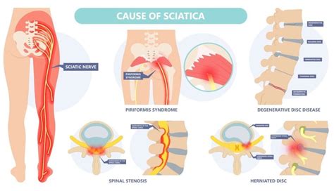 What Is Sciatica Boost Physio