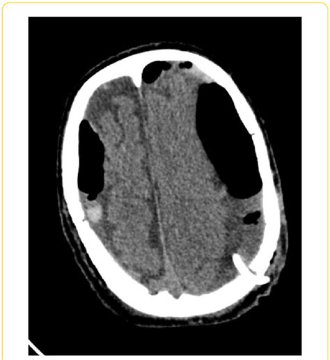 Initial Ct Scan Showing Tension Pneumocephalus Download Scientific
