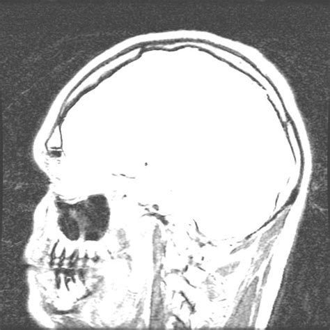 Lee 2 Mri Mris