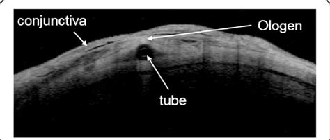 As Oct Image Of Bleb Over Ologen On Postoperative Day 1 Healthy Bleb Download Scientific
