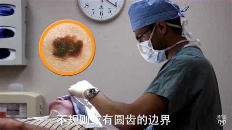 一分钟识别黑色素瘤腾讯视频