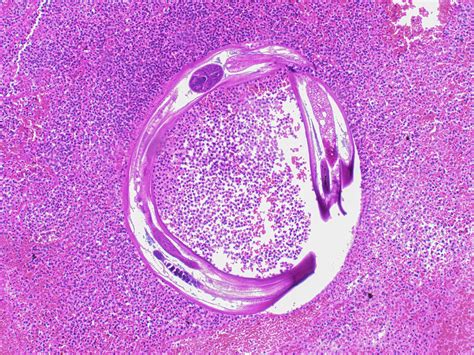 Jerad Gardner Md On Twitter Rt Zucchiatti Enterobius Vermicularis