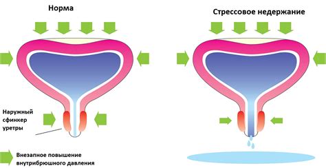 Недержание мочи у женщин ♻️️ причины симптомы методы лечения Medcity