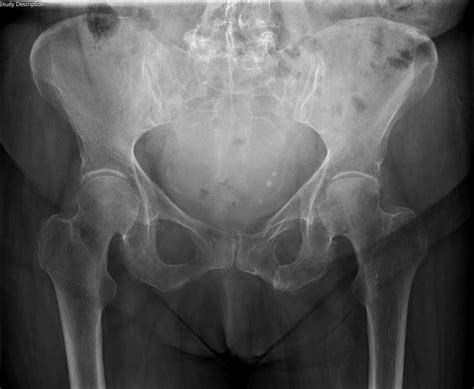 Preoperative X Ray Of A Combined Anterior And Posterior Pelvic Ring