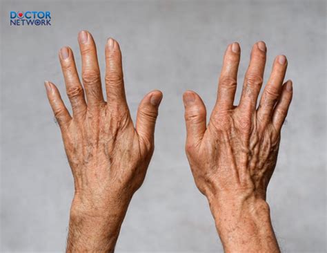 Top 5 Common Causes Of Brown Spots On The Hands Doctor Network