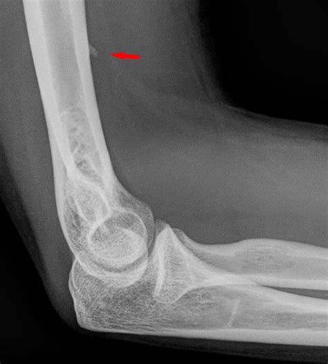 Supracondylar Process Of The Humerus Alchetron The Free Social