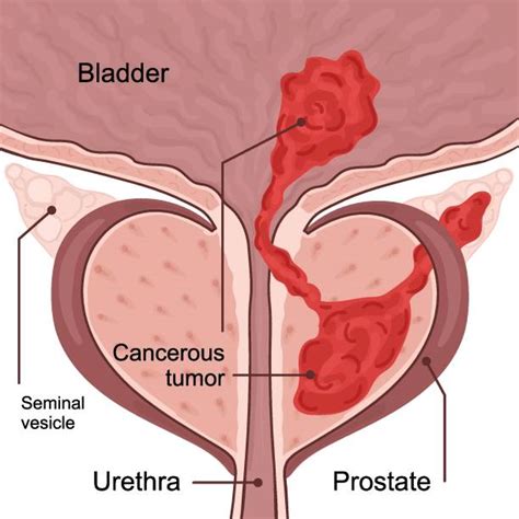 30 Clip Art Of Male Prostate Diagram Stock Illustrations Royalty Free Vector Graphics And Clip