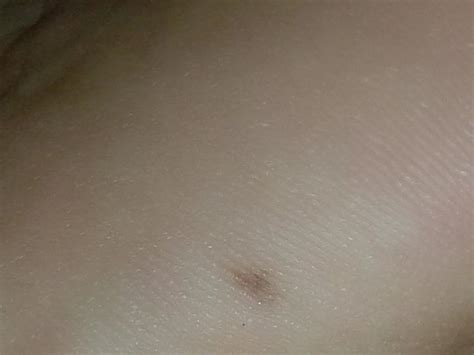 Invasive Melanoma 43mm Surgical Removal And Radiation Now What R