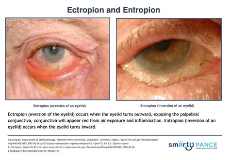 Entropion And Ectropion Causes Symptoms And Treatment Ectropion Boise