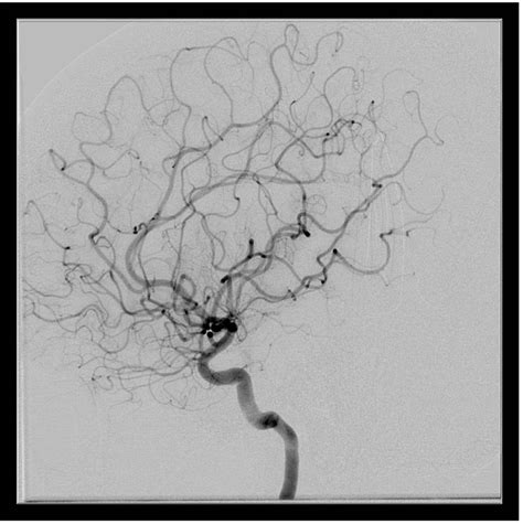 Figure 1 From Factors Affecting The Obliteration Rate Of Intracranial Aneurysms Treated With A