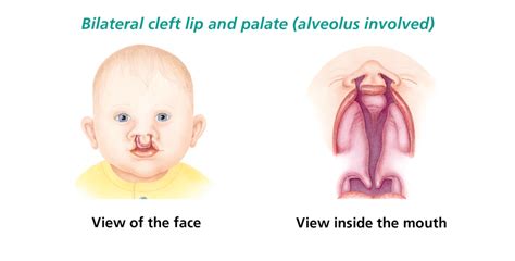 Bilateral Cleft Lip Classification Of Cleft Lip And Palate Balaji