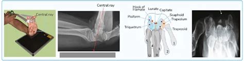 Special X Ray Views In Orthopedics For Neet Pg Prepladder