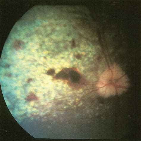 Ocular Manifestations Of Systemic Disease Veterian Key