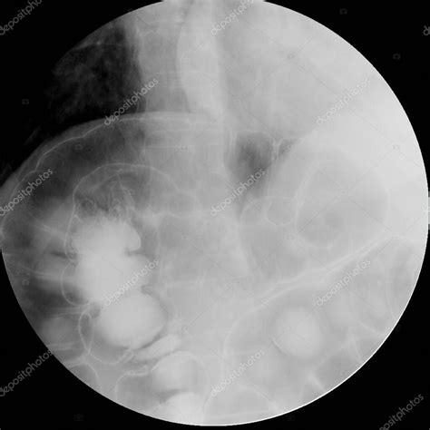 Imagen De Enema De Bario O Vista De Rayos X Colorrectales Que Muestra