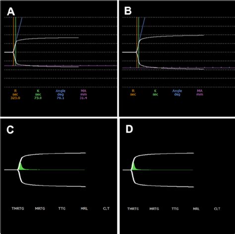 Teg ® Trace And V Curve Obtained From Healthy And Tia Individuals A