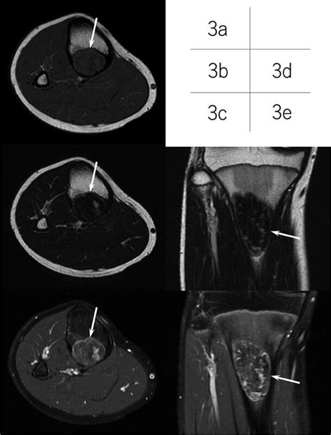 A 12 Year Old Man With Nonossifying Fibroma Of The Right Tibia Download Scientific Diagram