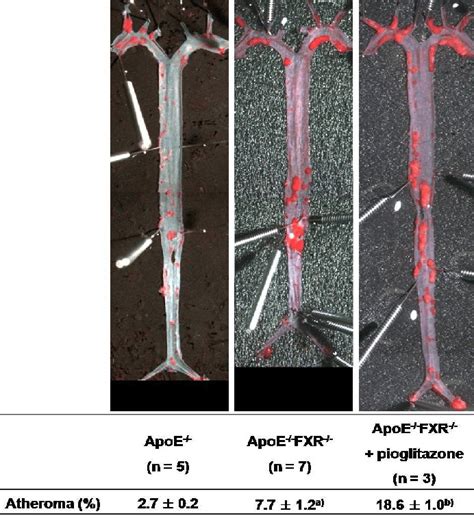 An Atheroma Of The Aorta Stained With Oil Red O A P 003 Compared To