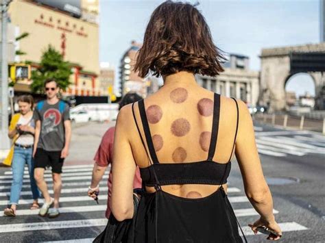 Cupping Therapy How Effective Is It Does It Have Any Side Effects